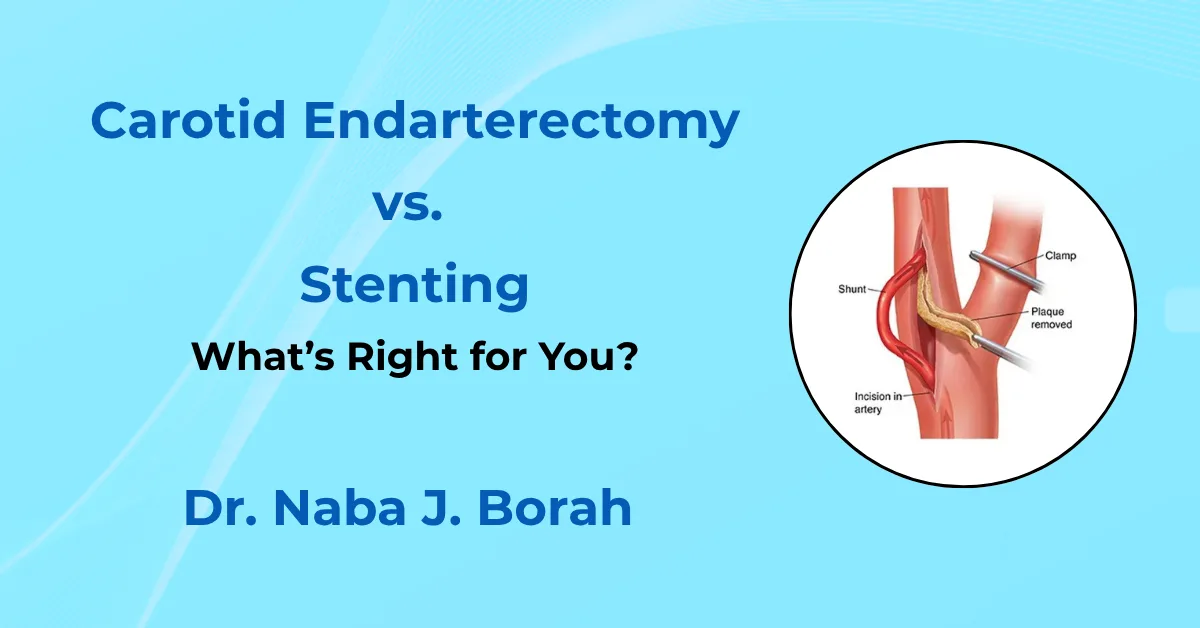 Carotid Endarterectomy vs. Stenting – What’s Right for You? - Dr Naba J ...